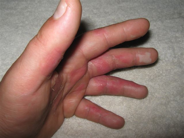 Unexpected sparklers explosion